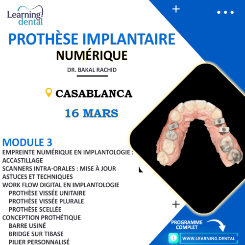 Prothèse implantaire numérique - Learning.Dental